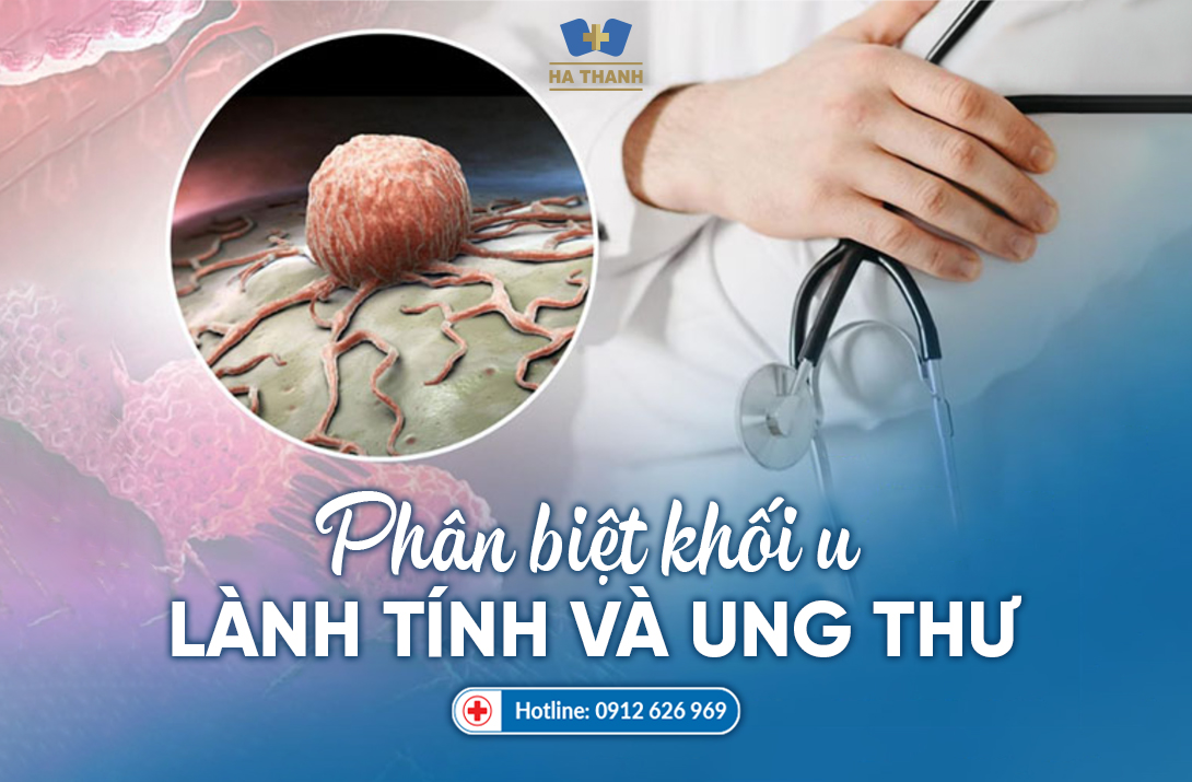 Phân biệt khối u lành tính và khối u ung thư